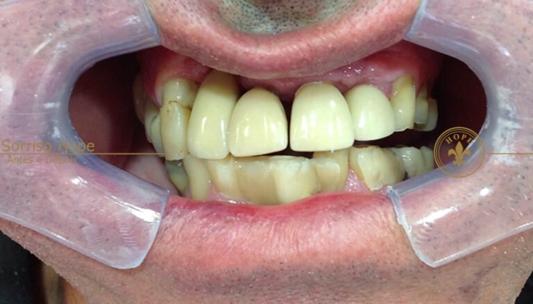 PROTOCOLO SOBRE IMPLANTES CERÂMICOS E CONVENCIONAIS – Hope Odontologia