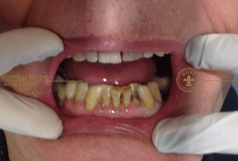 PROTOCOLO SOBRE IMPLANTES CERÂMICOS E CONVENCIONAIS – Hope Odontologia